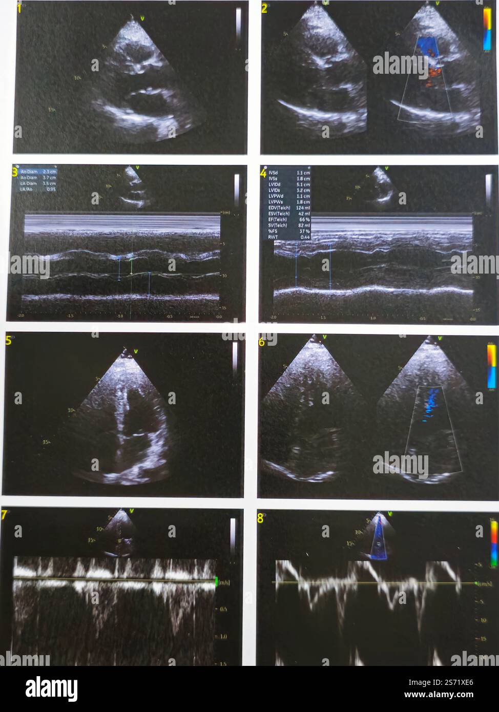 Echocardiography or cardiac ultrasound shows normal values except for ...