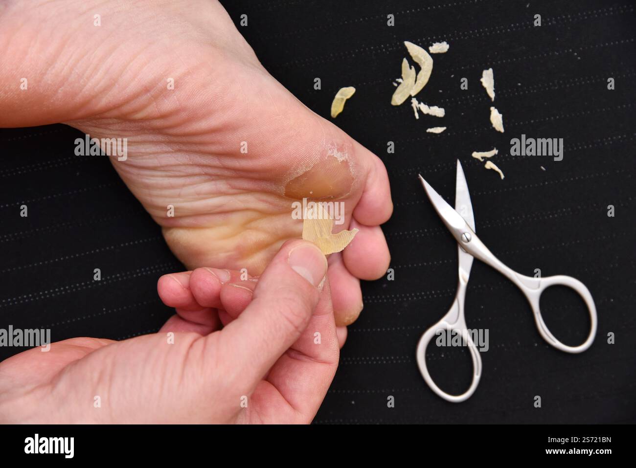 Man cuts rough scissors, calluses, corns on the soles. Foot care at ...