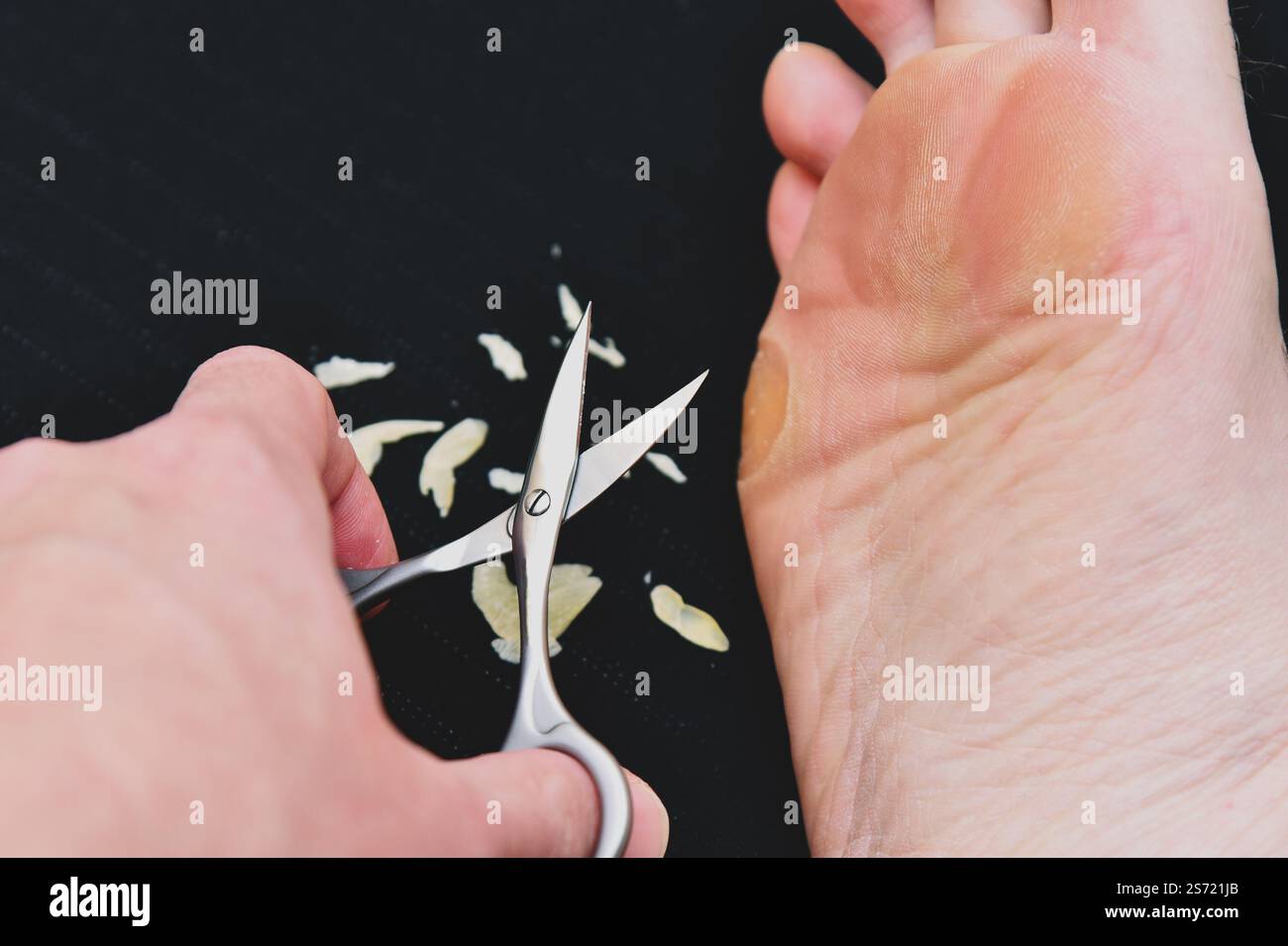 Foot health care, cutting off calluses with sharp scissors. Corns. Foot ...