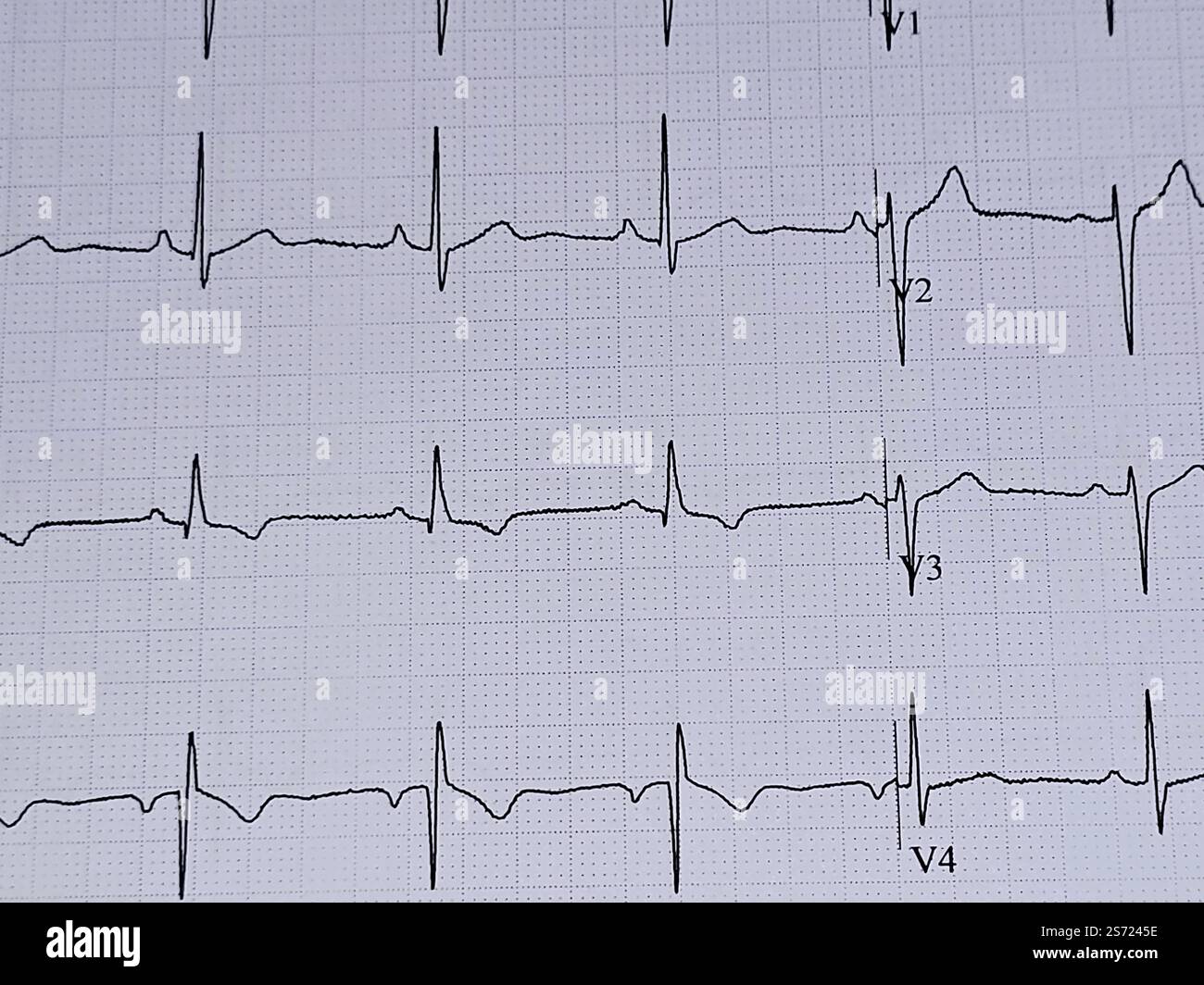 ECG ElectroCardioGraph paper that shows inferolateral T wave changes ...