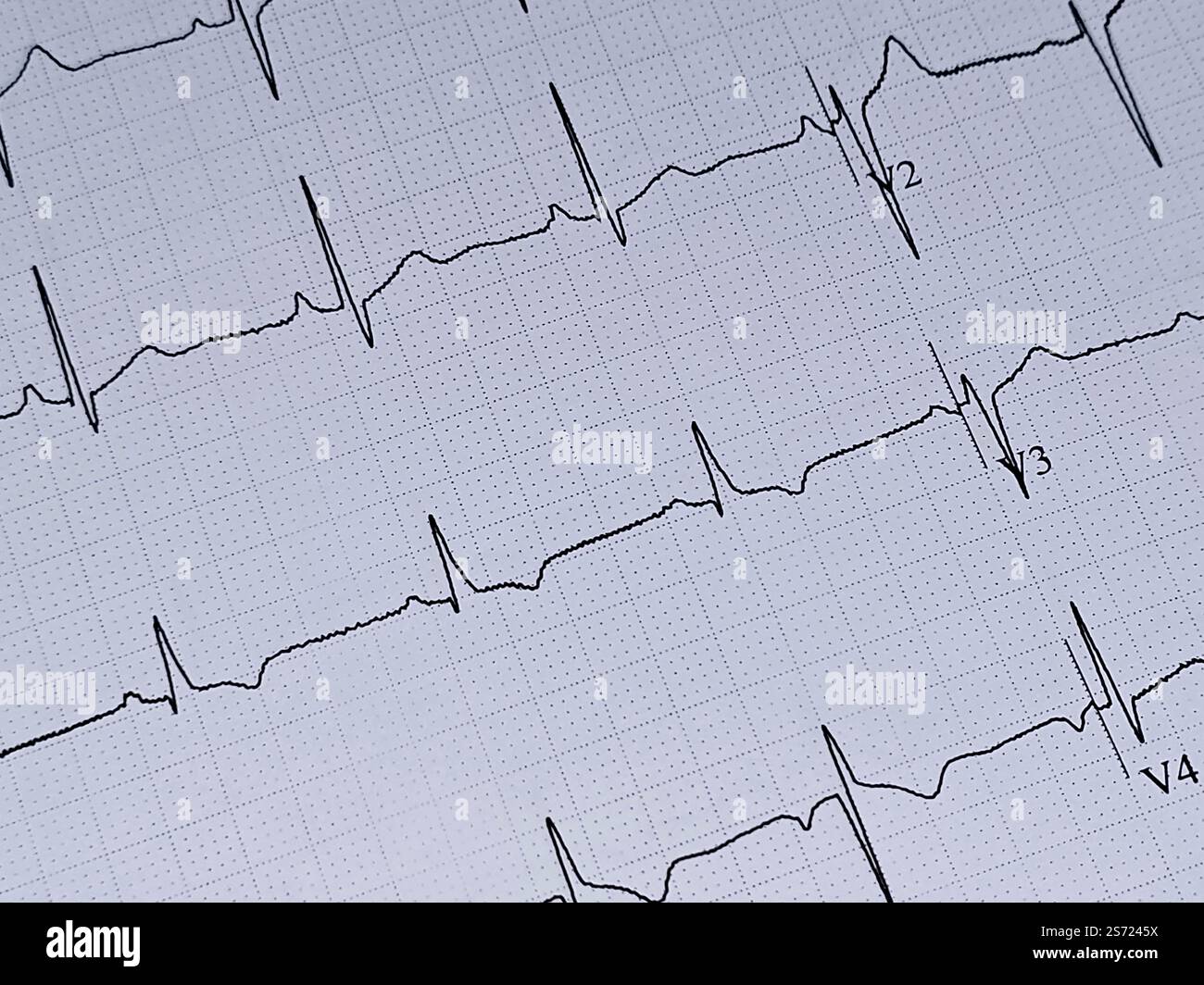 ECG ElectroCardioGraph paper that shows inferolateral T wave changes for clinical correlation ...