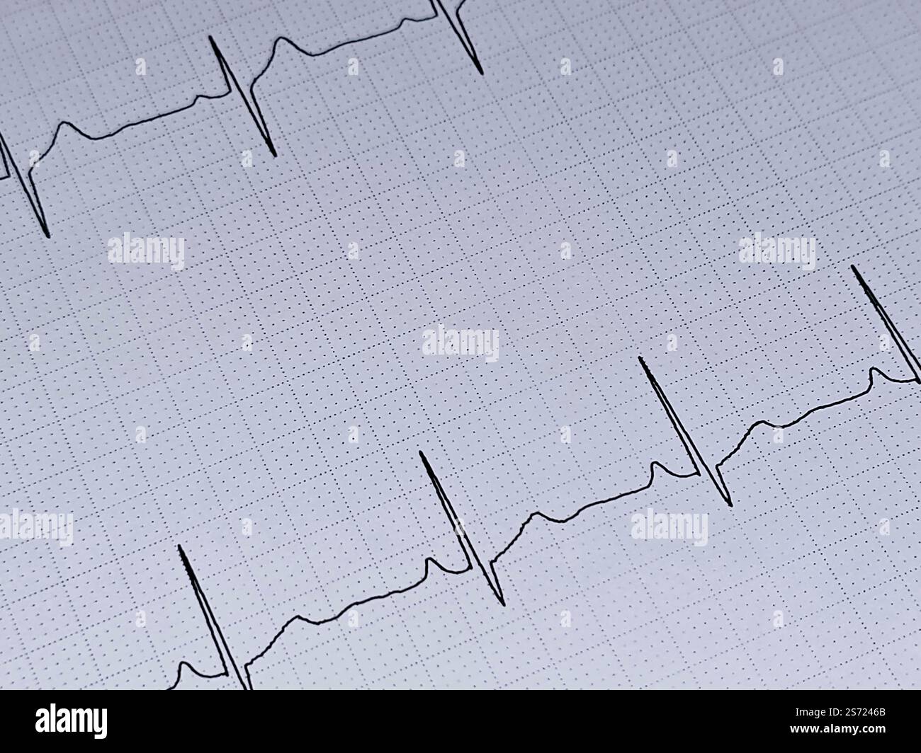 ECG ElectroCardioGraph paper that shows inferolateral T wave changes for clinical correlation ...