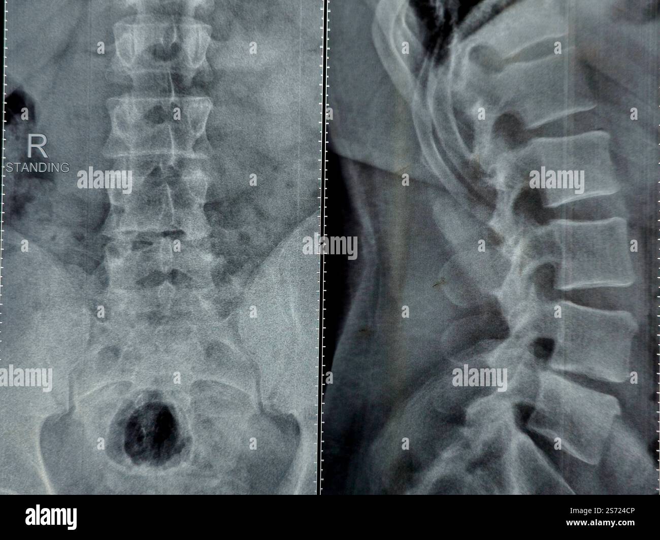 X-ray lumbosacral spine shows straightening of lumbar lordosis due to ...