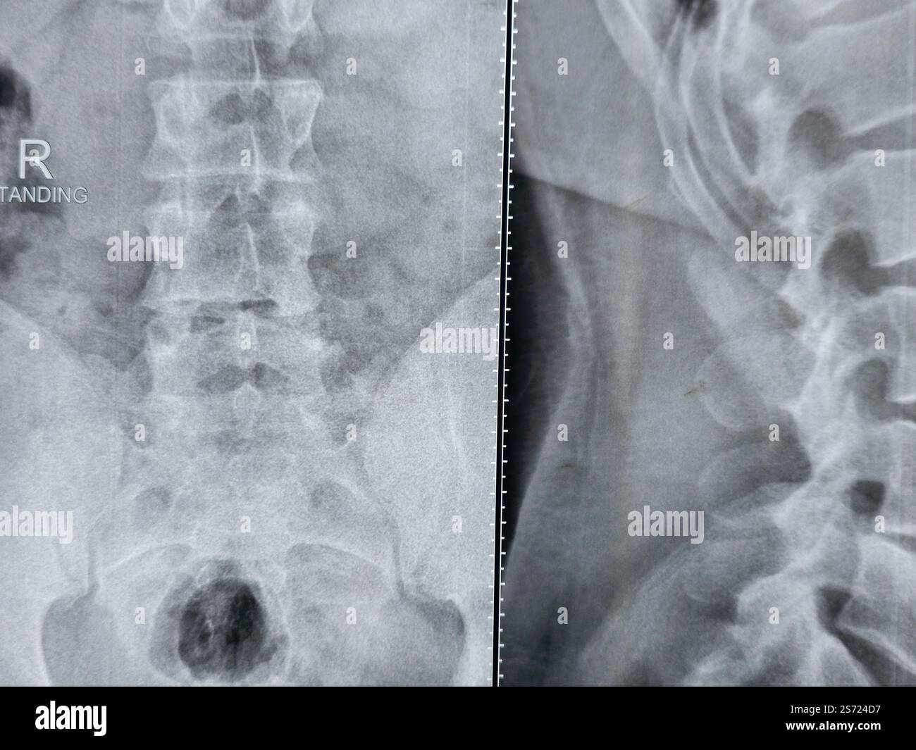X-ray lumbosacral spine shows straightening of lumbar lordosis due to ...