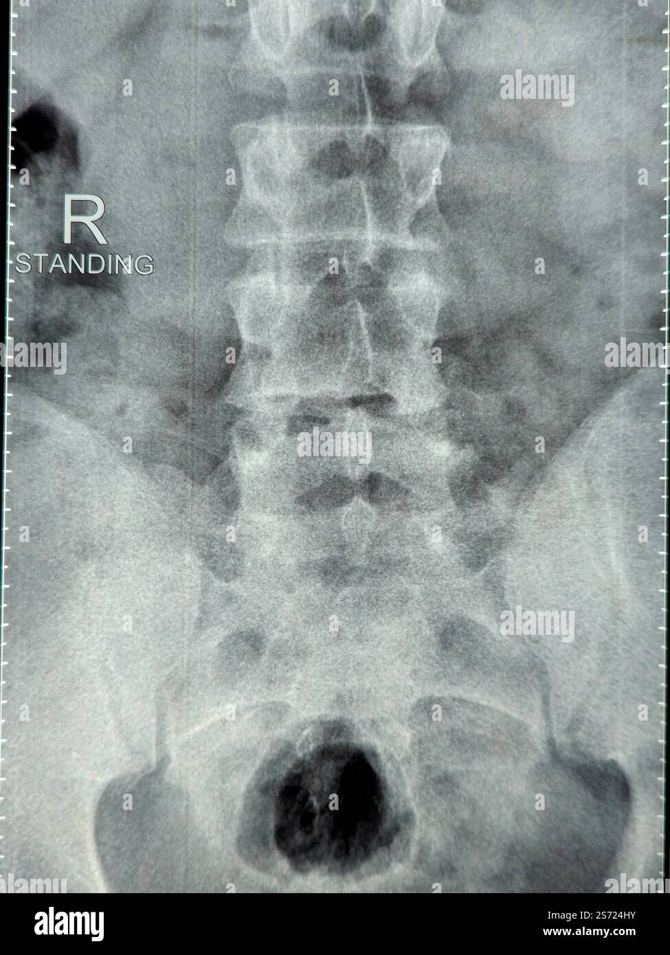 X-ray lumbosacral spine shows straightening of lumbar lordosis due to ...