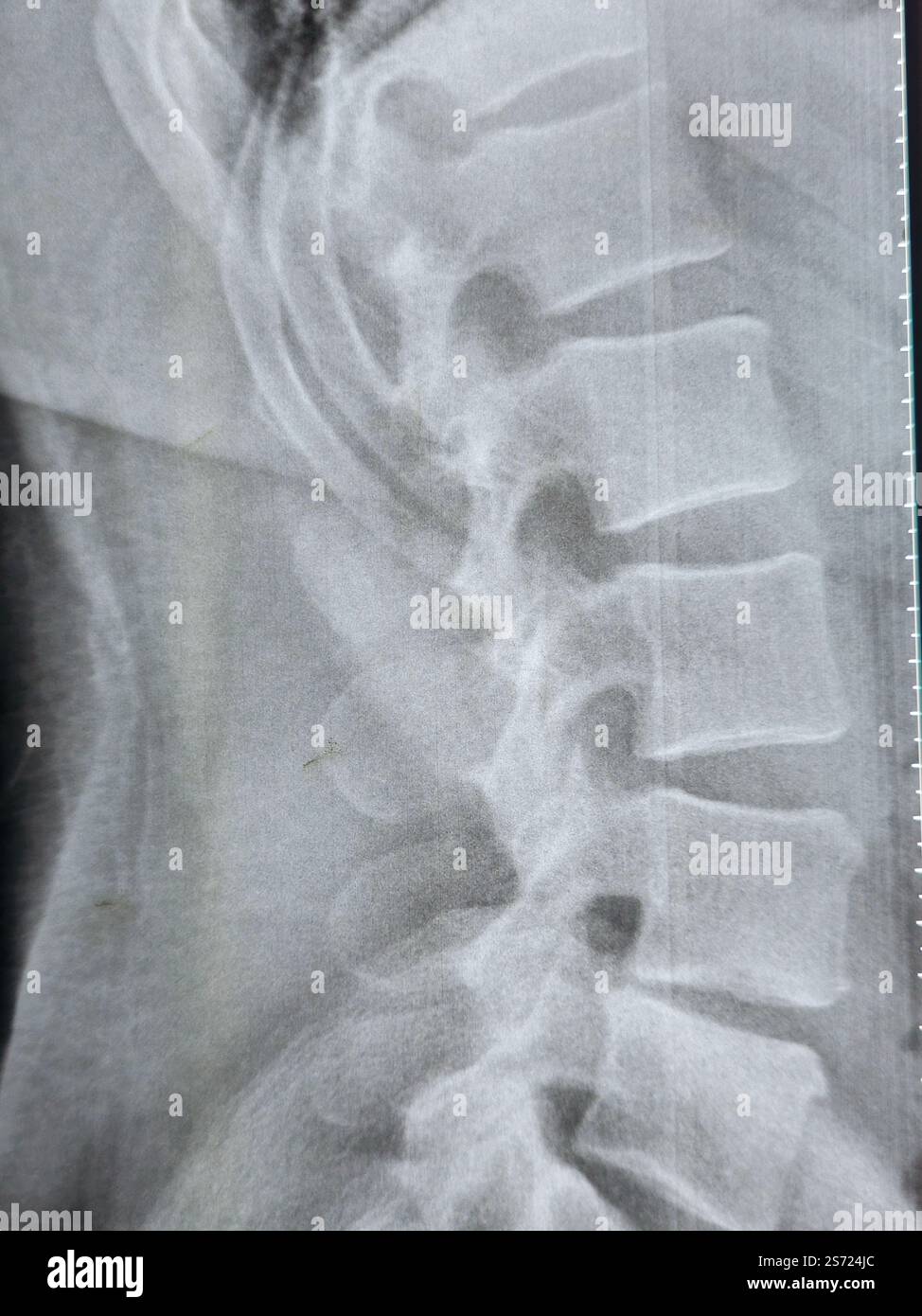 X-ray lumbosacral spine shows straightening of lumbar lordosis due to ...