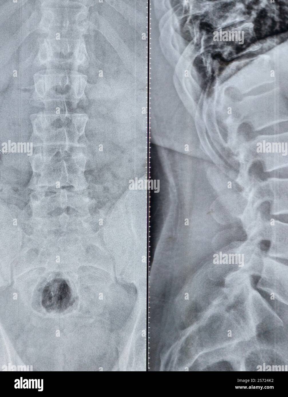 X-ray lumbosacral spine shows straightening of lumbar lordosis due to ...