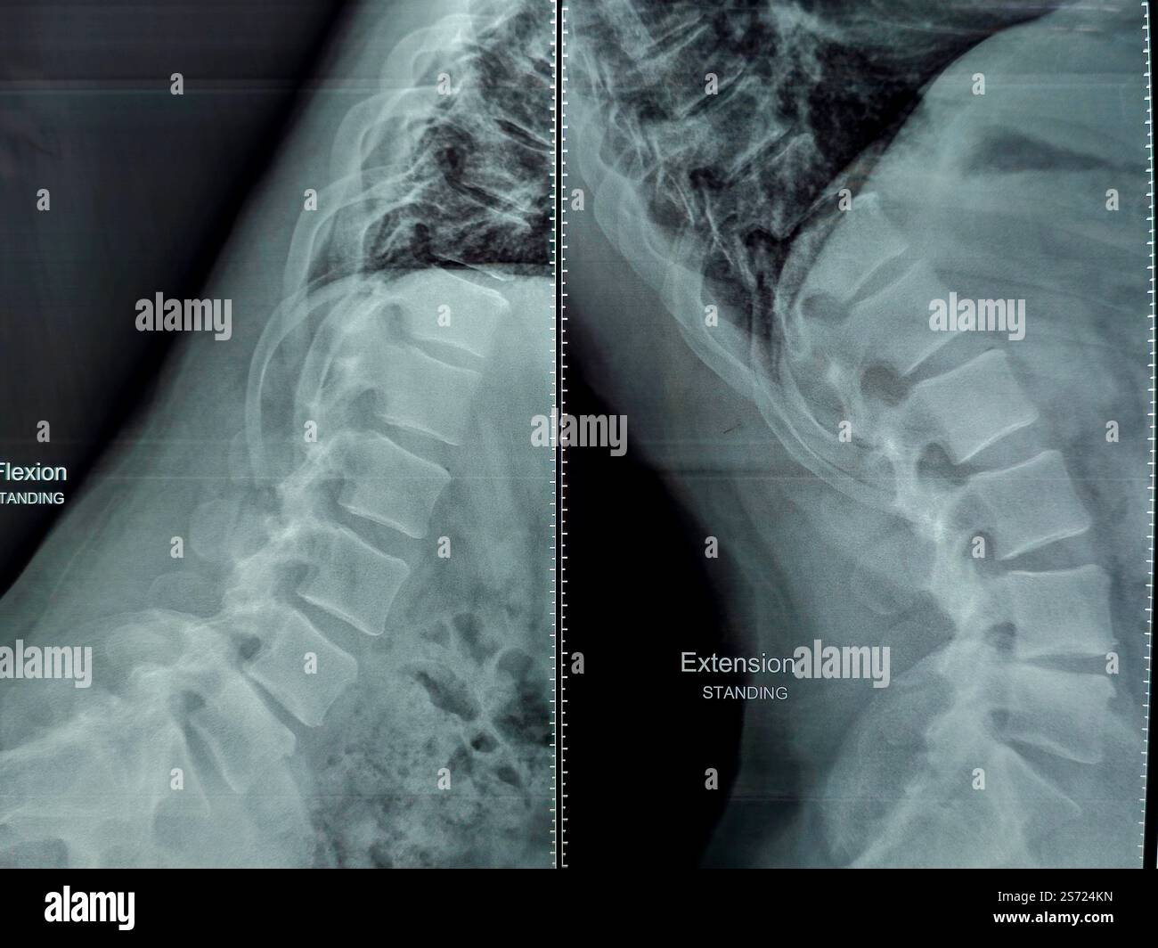 X-ray lumbosacral spine shows straightening of lumbar lordosis due to ...