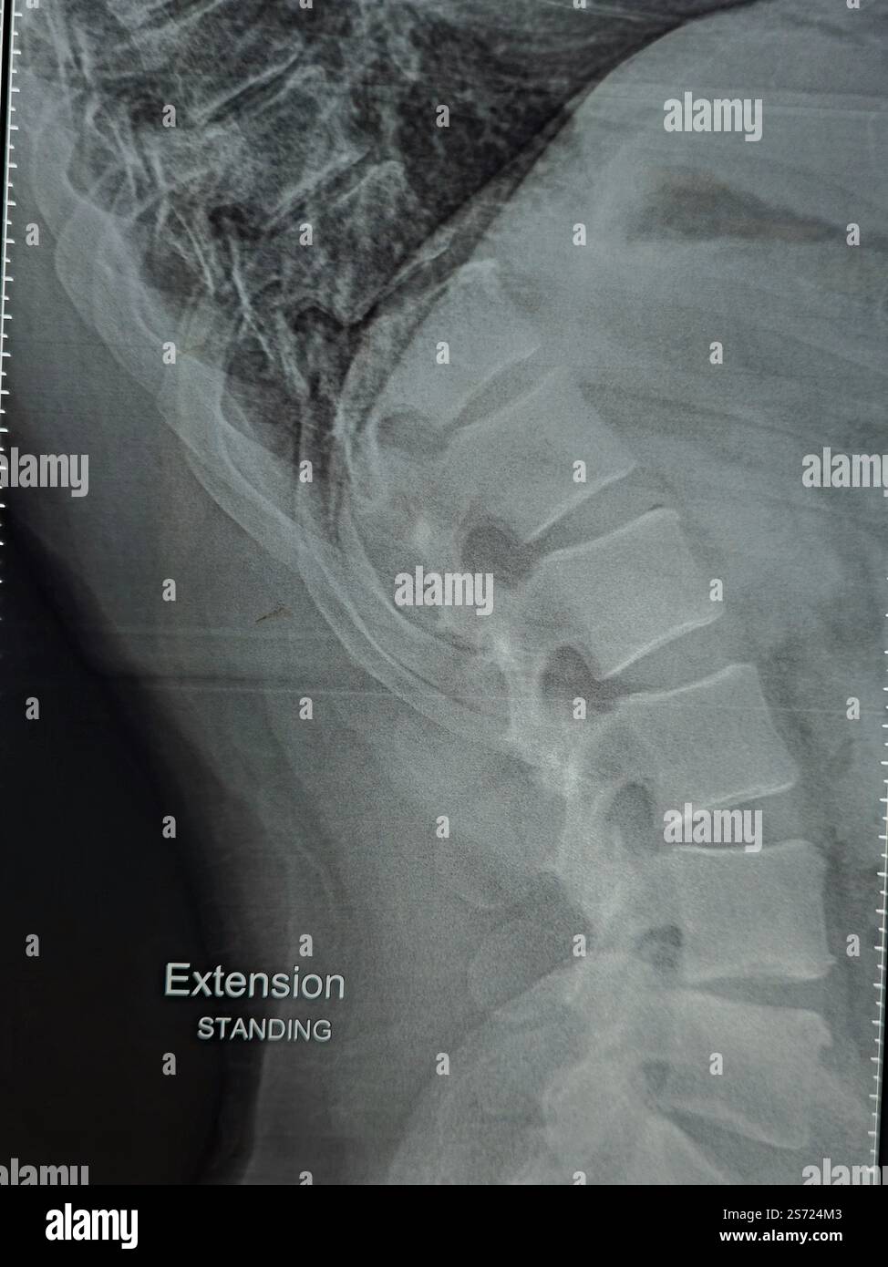 X-ray lumbosacral spine shows straightening of lumbar lordosis due to ...