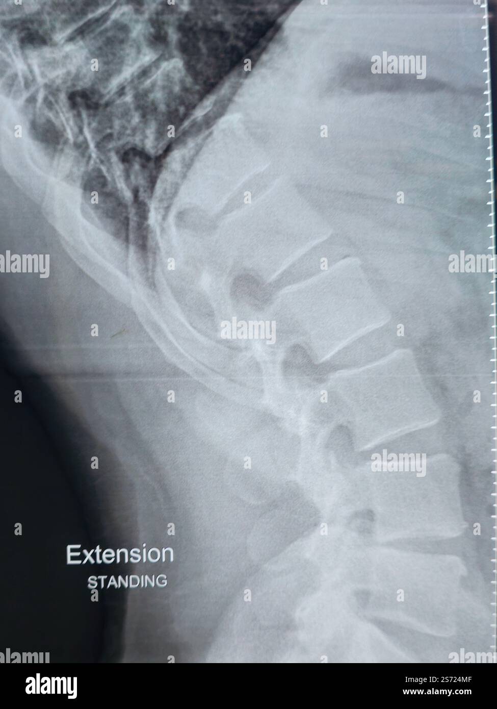 X-ray lumbosacral spine shows straightening of lumbar lordosis due to ...