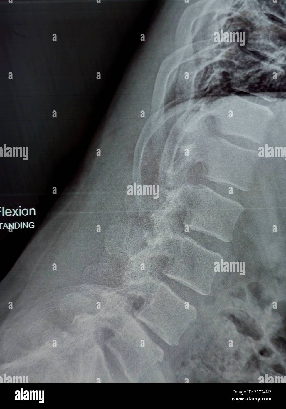 X-ray lumbosacral spine shows straightening of lumbar lordosis due to ...