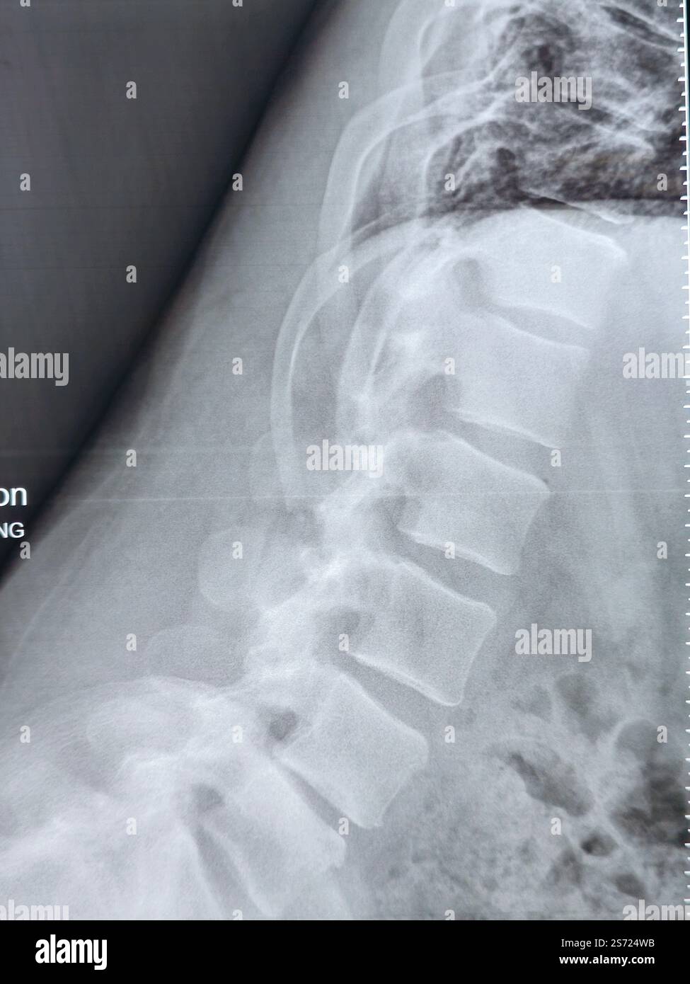 X-ray lumbosacral spine shows straightening of lumbar lordosis due to ...