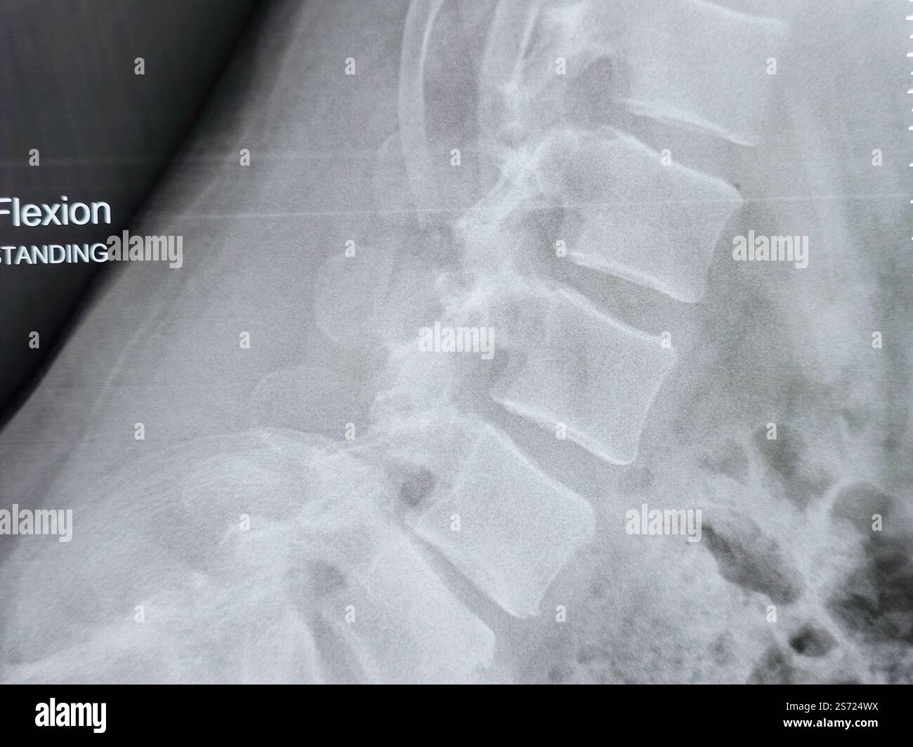 X-ray lumbosacral spine shows straightening of lumbar lordosis due to ...