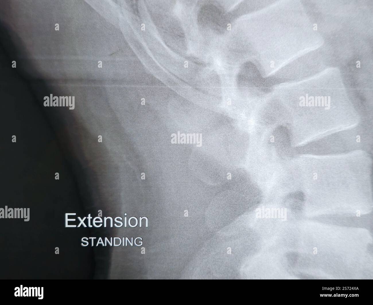 X-ray lumbosacral spine shows straightening of lumbar lordosis due to ...