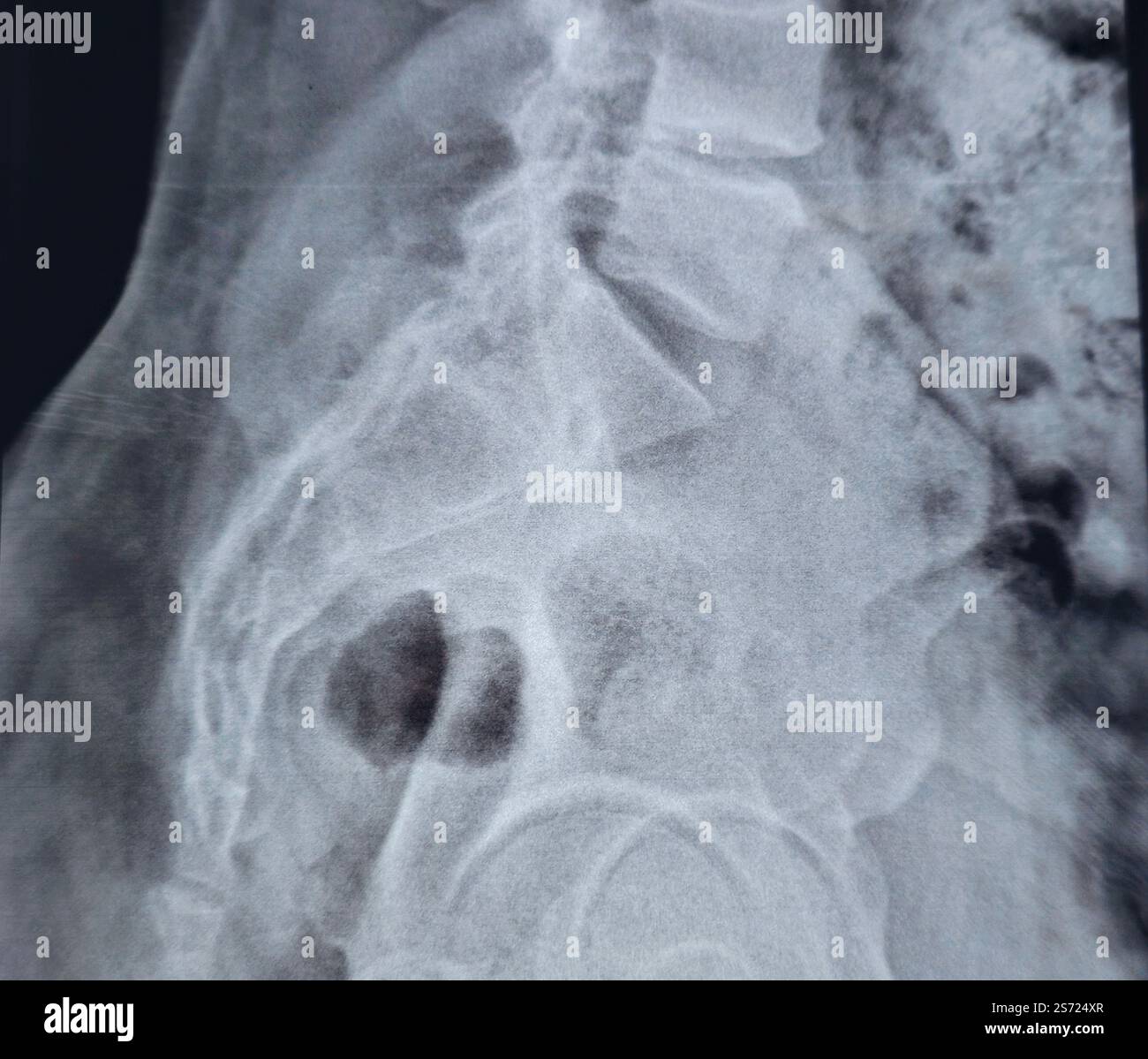 X-ray lumbosacral spine shows straightening of lumbar lordosis due to ...