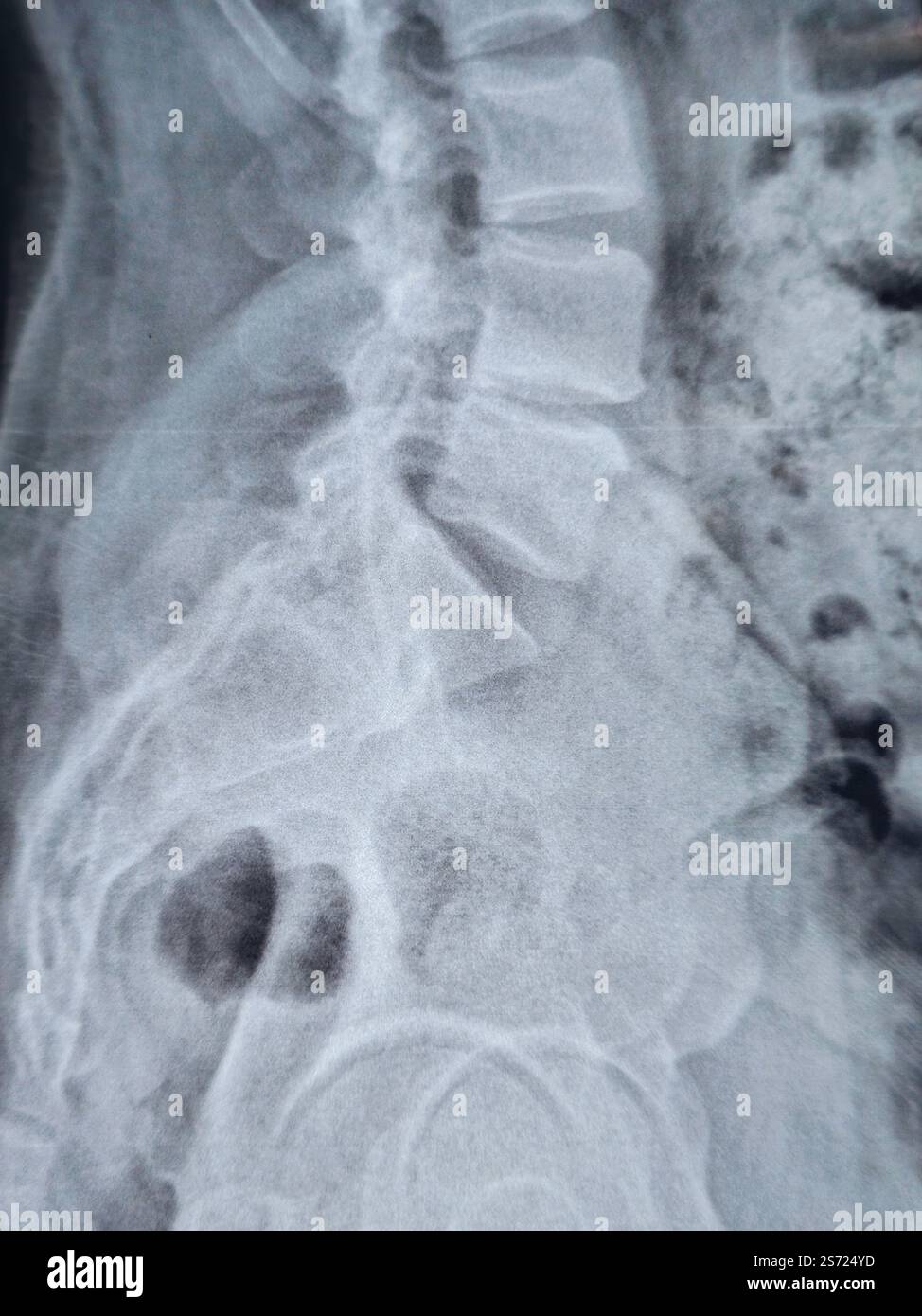 X-ray lumbosacral spine shows straightening of lumbar lordosis due to ...