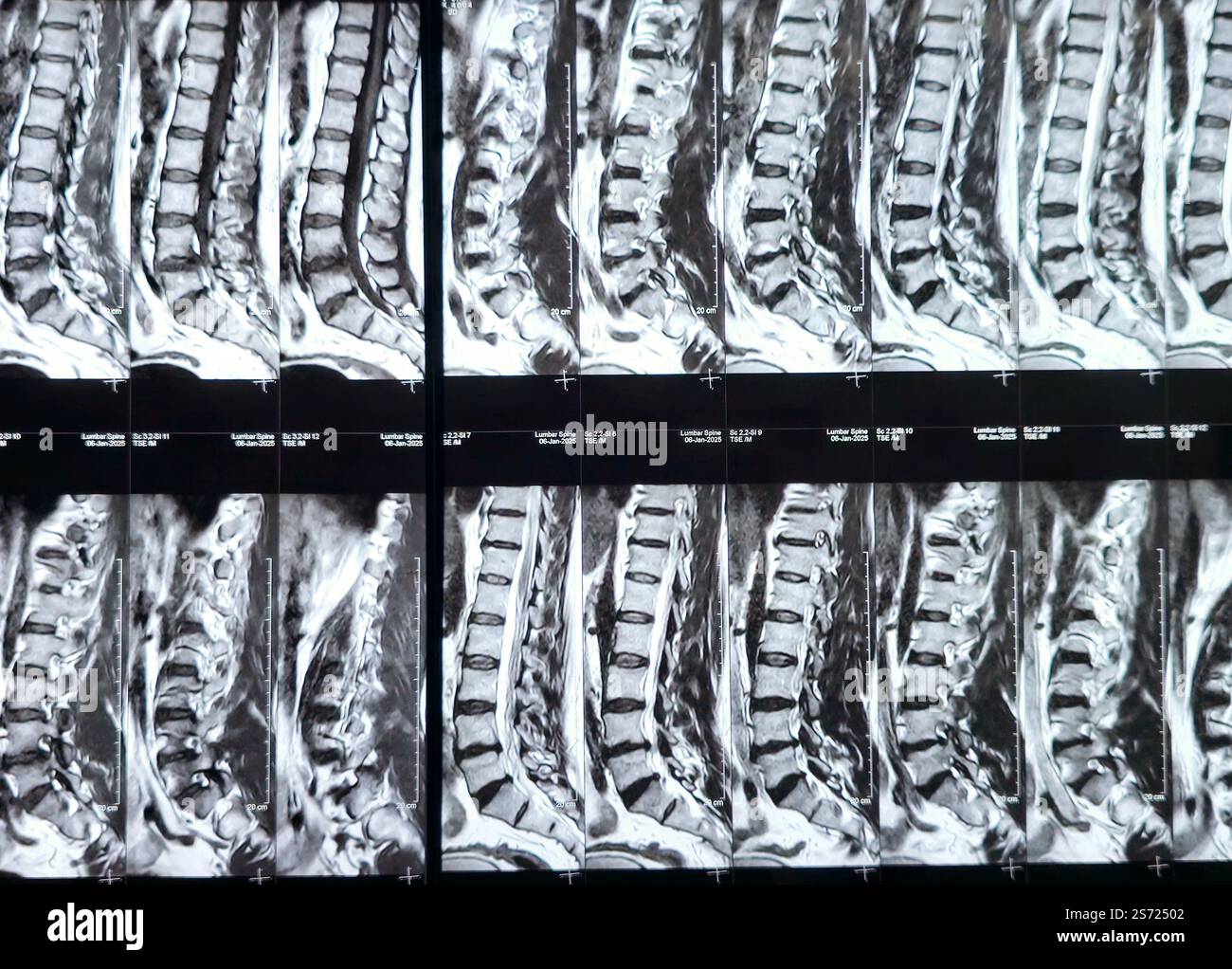 Magnetic Resonance Imaging MRI of the lumbosacral spine shows ...