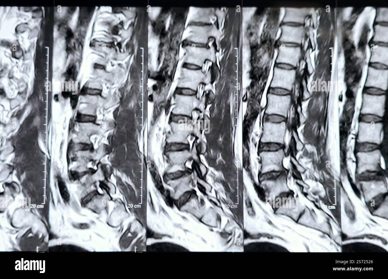 Magnetic Resonance Imaging MRI of the lumbosacral spine shows ...