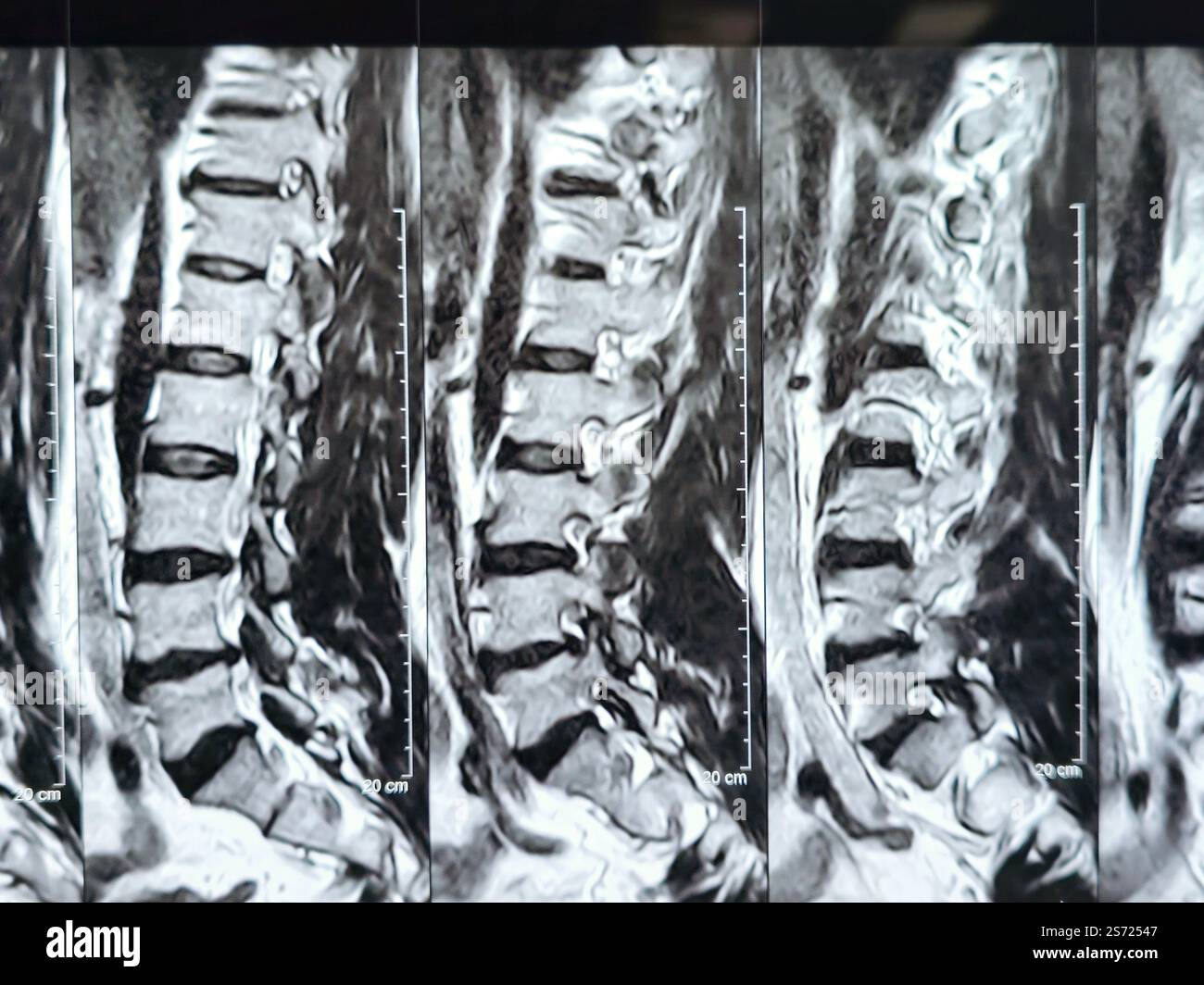 Magnetic Resonance Imaging MRI of the lumbosacral spine shows Spondylodegenerative changes of ...