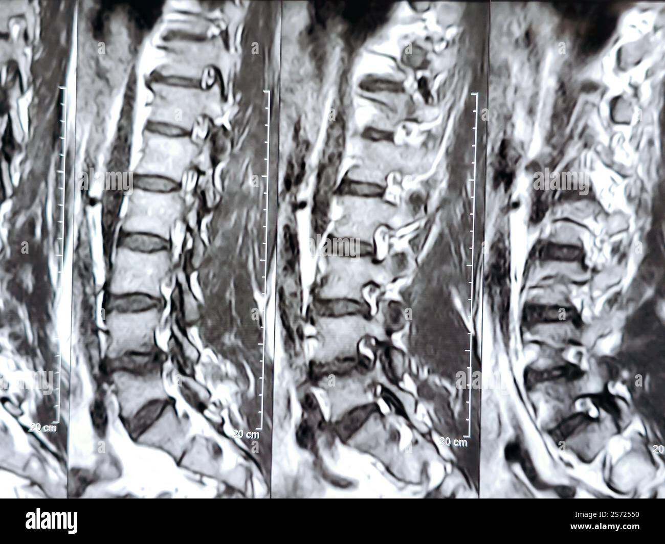Magnetic Resonance Imaging MRI of the lumbosacral spine shows Spondylodegenerative changes of ...