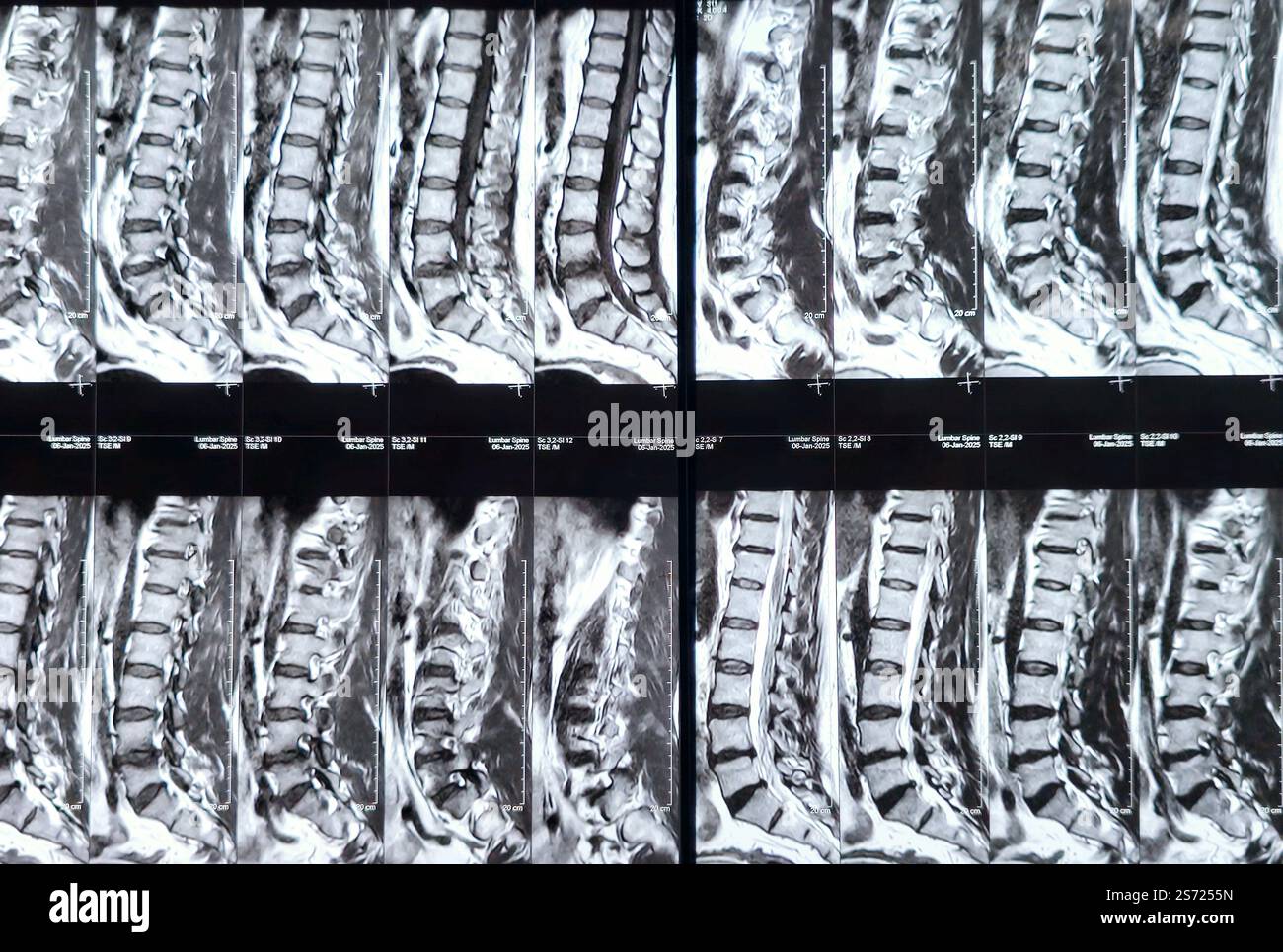 Magnetic Resonance Imaging MRI of the lumbosacral spine shows Spondylodegenerative changes of ...