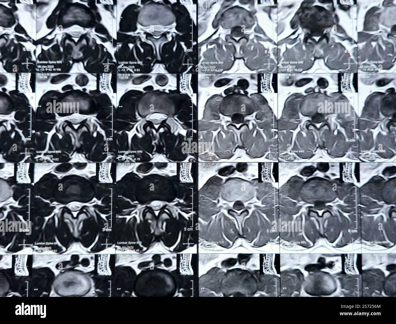 Magnetic Resonance Imaging MRI of the lumbosacral spine shows ...
