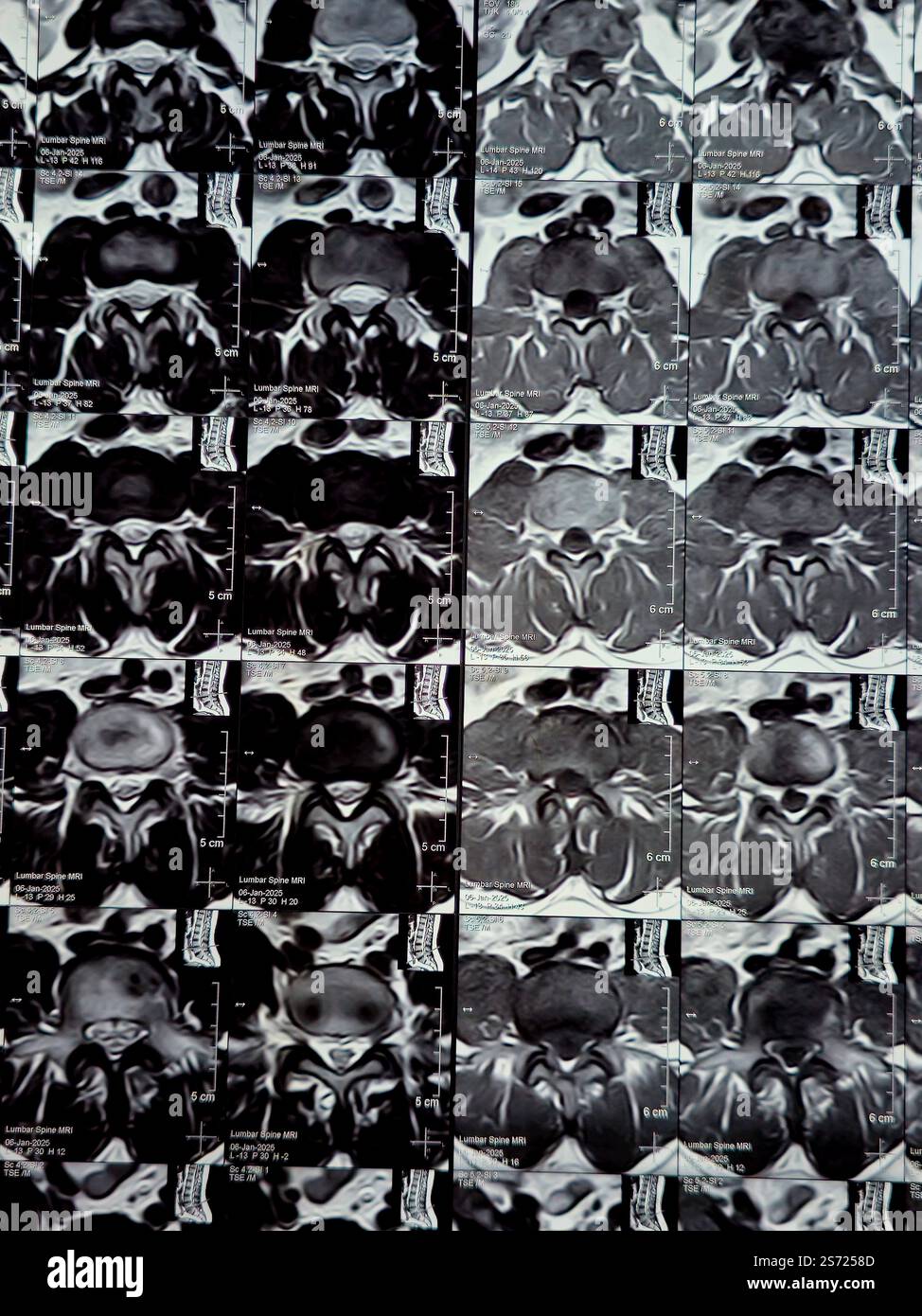 Magnetic Resonance Imaging MRI of the lumbosacral spine shows Spondylodegenerative changes of ...