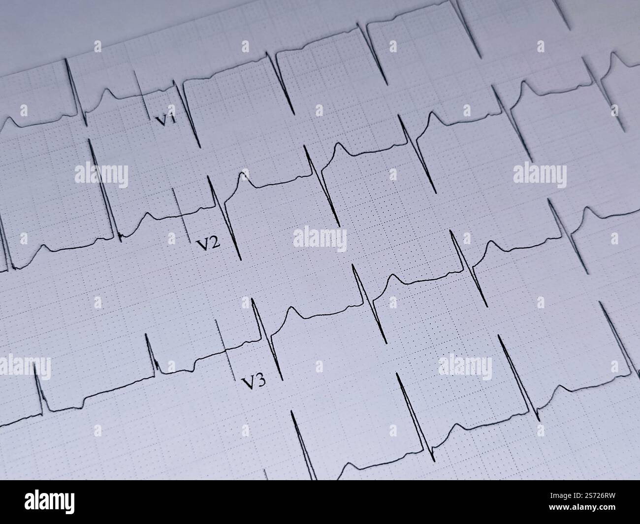 An Electrocardiogram Ecg Or Ekg Within Normal Ecg For A 55 Years Old