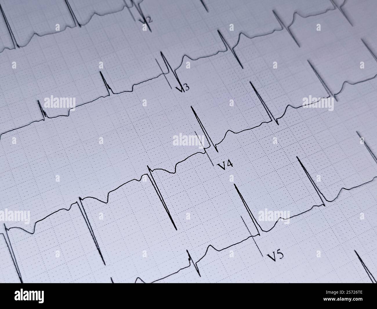 an electrocardiogram ECG or EKG, within normal ECG for a 55 years old ...