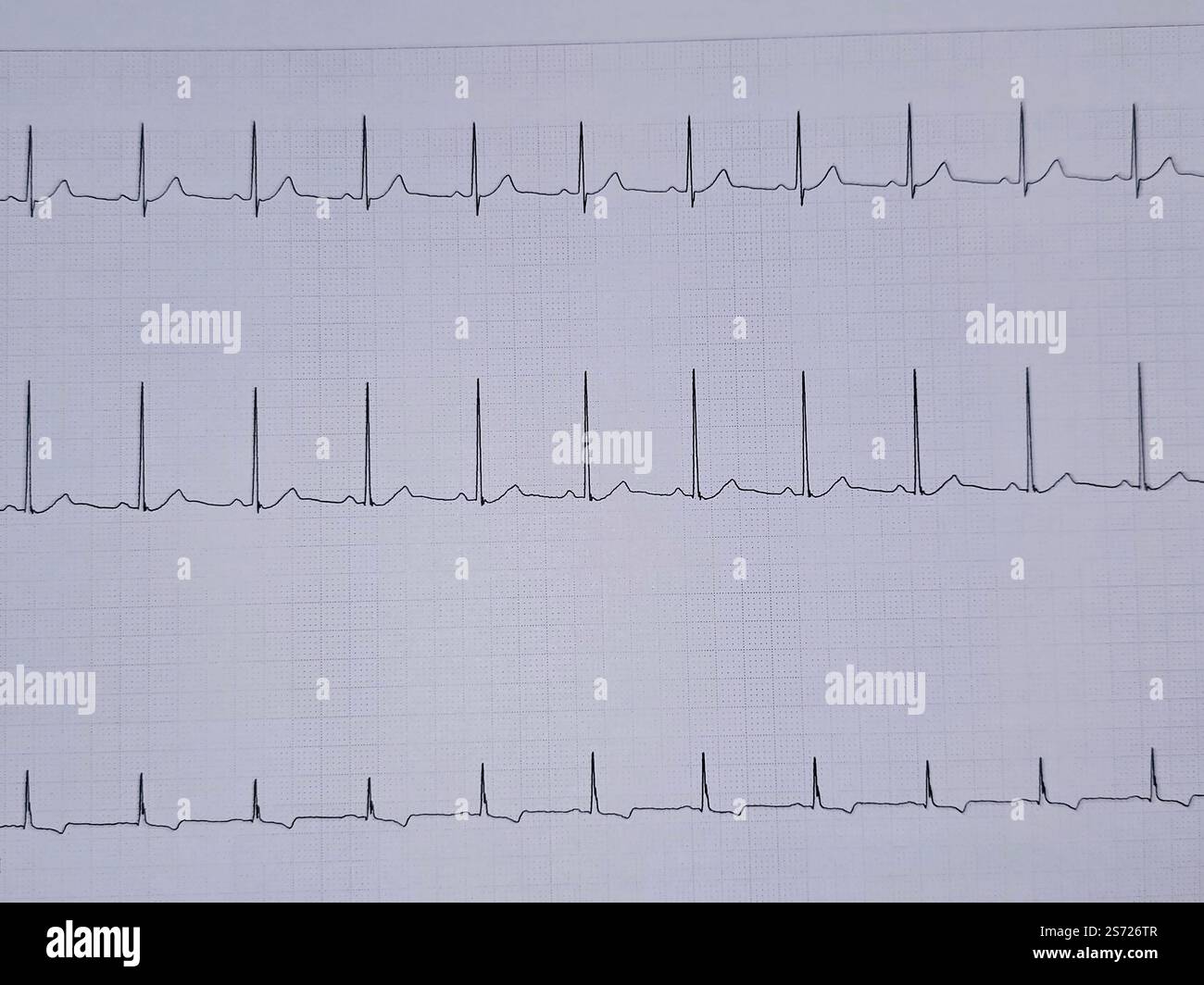 An Electrocardiogram Ecg Or Ekg Within Normal Ecg For A 55 Years Old
