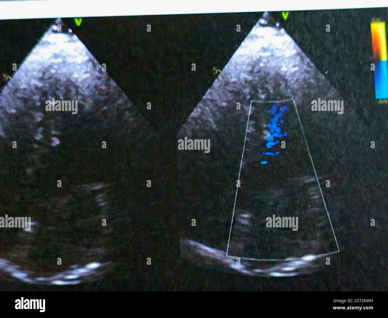 Echocardiography or cardiac ultrasound shows normal values except for ...