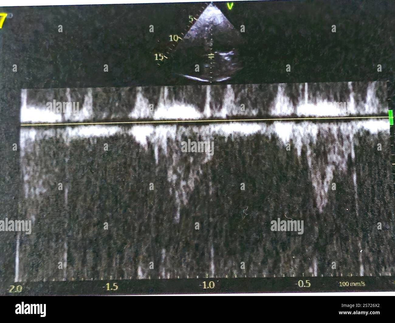 Echocardiography or cardiac ultrasound shows normal values except for ...