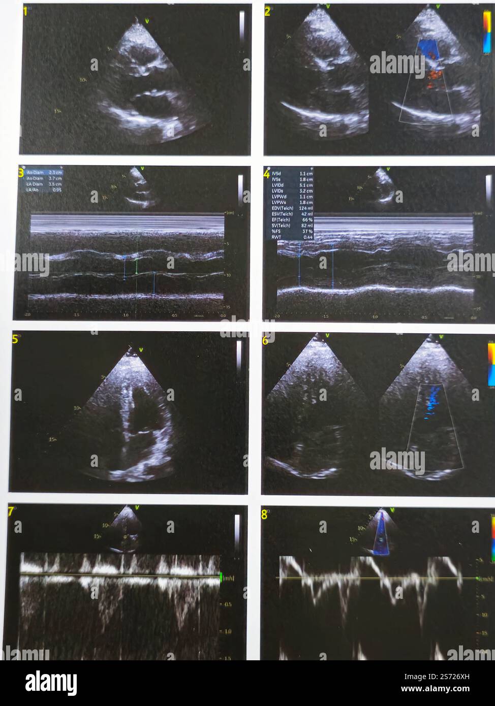 Echocardiography or cardiac ultrasound shows normal values except for ...