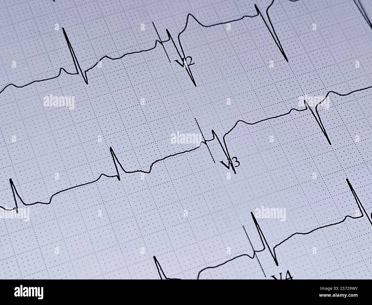 ECG ElectroCardioGraph paper that shows inferolateral T wave changes ...