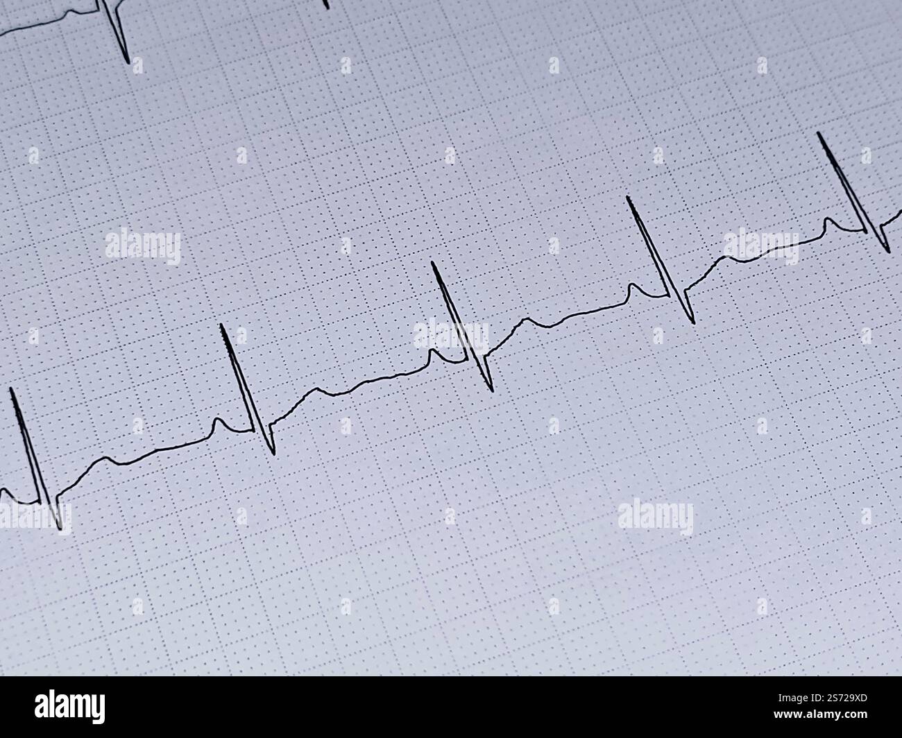 ECG ElectroCardioGraph paper that shows inferolateral T wave changes for clinical correlation ...