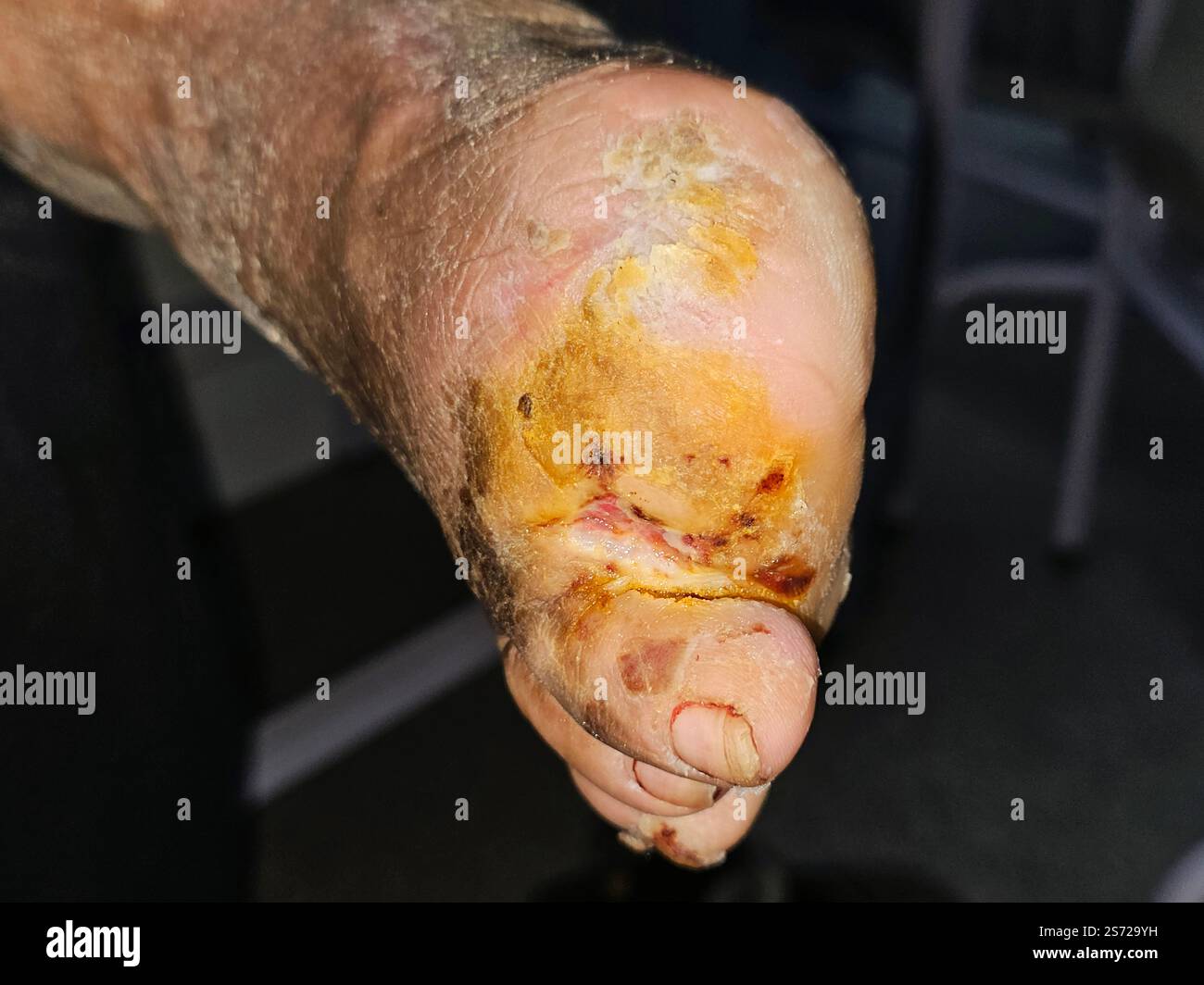 diabetic right foot with previously amputated big toe hallux and ...