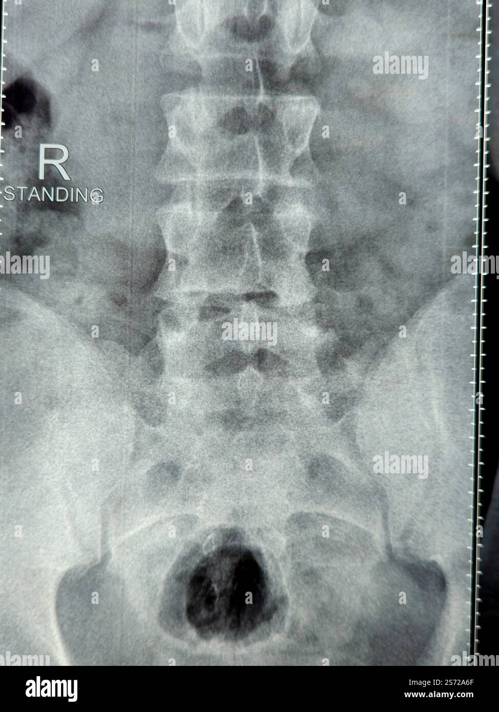 X-ray lumbosacral spine shows straightening of lumbar lordosis due to ...