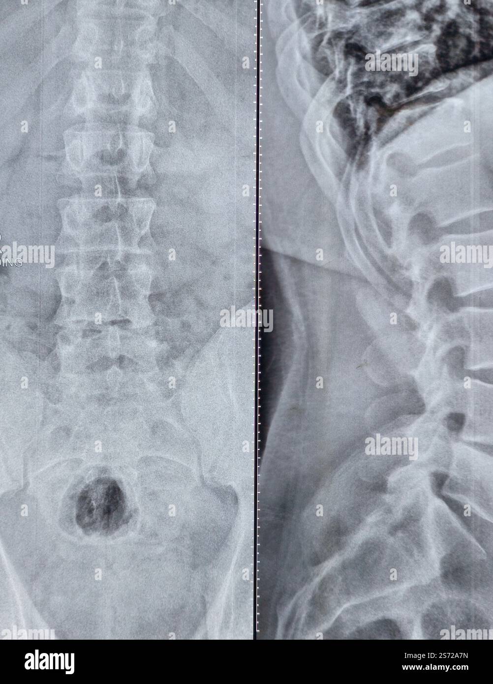 X-ray lumbosacral spine shows straightening of lumbar lordosis due to ...