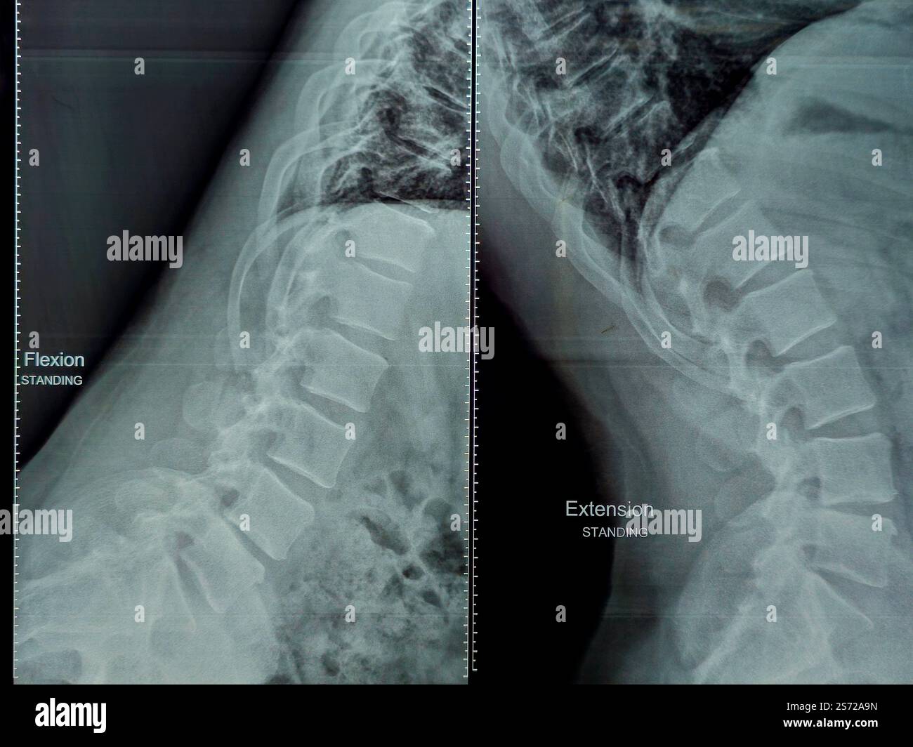 X-ray lumbosacral spine shows straightening of lumbar lordosis due to ...