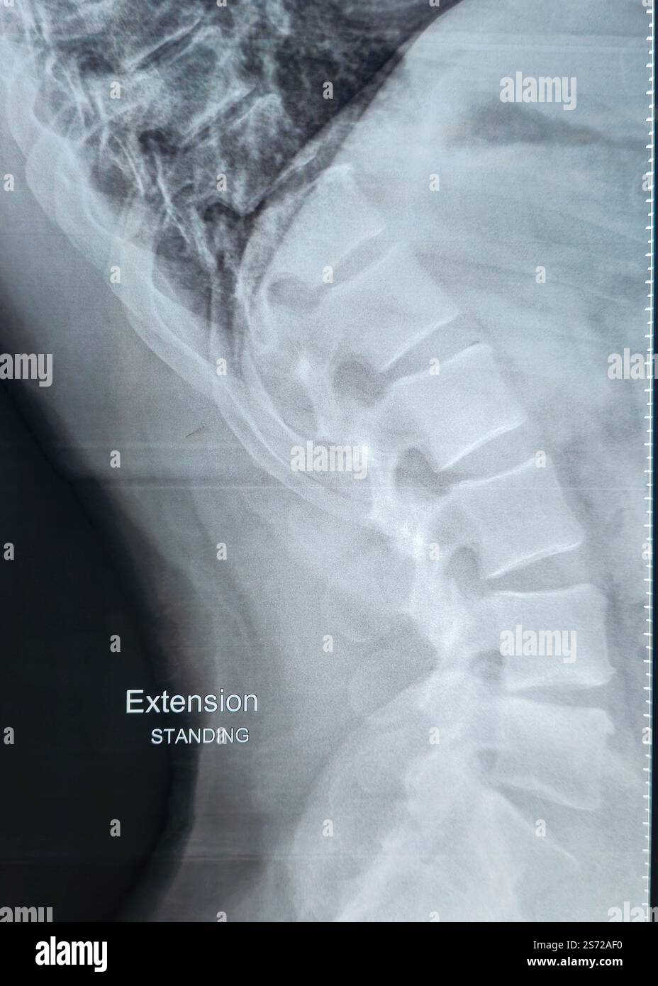 X-ray lumbosacral spine shows straightening of lumbar lordosis due to ...