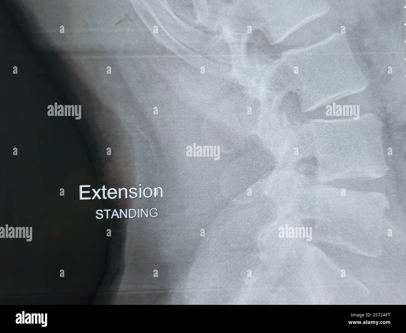 X-ray lumbosacral spine shows straightening of lumbar lordosis due to ...
