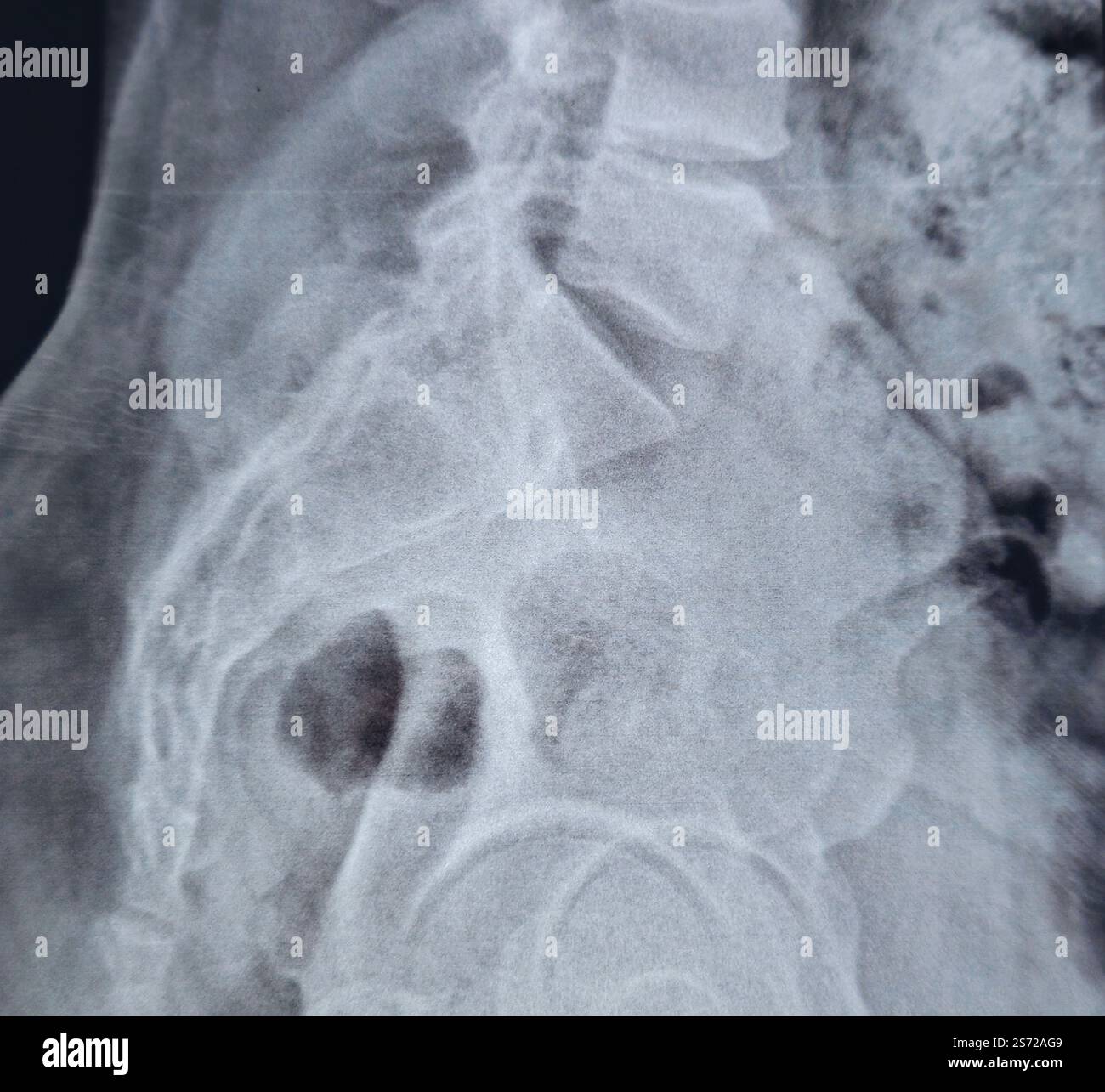 X-ray lumbosacral spine shows straightening of lumbar lordosis due to ...
