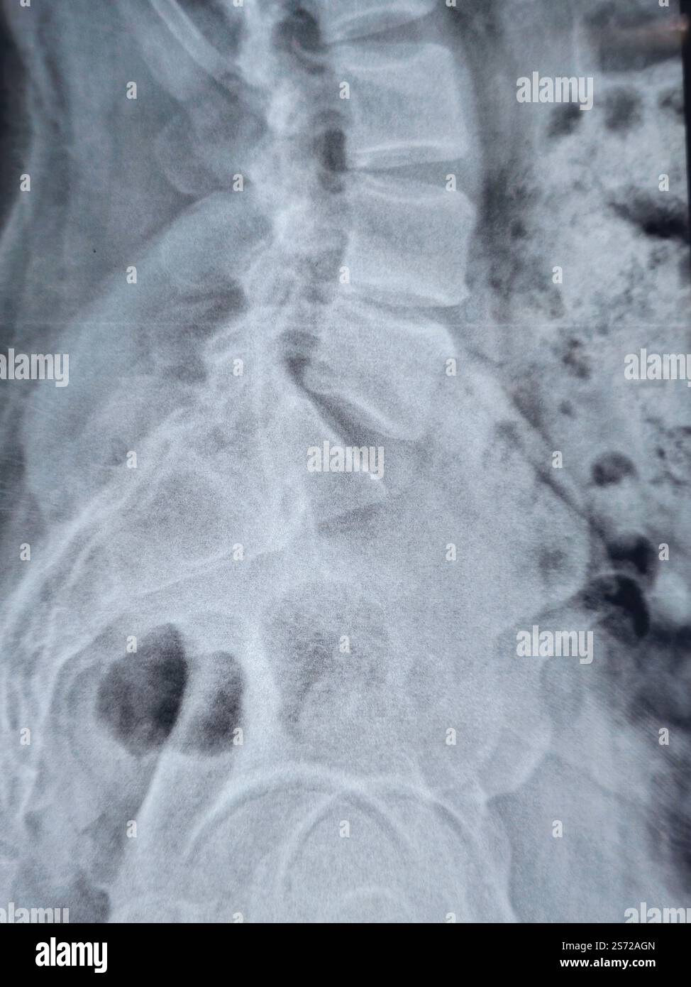 X-ray lumbosacral spine shows straightening of lumbar lordosis due to ...