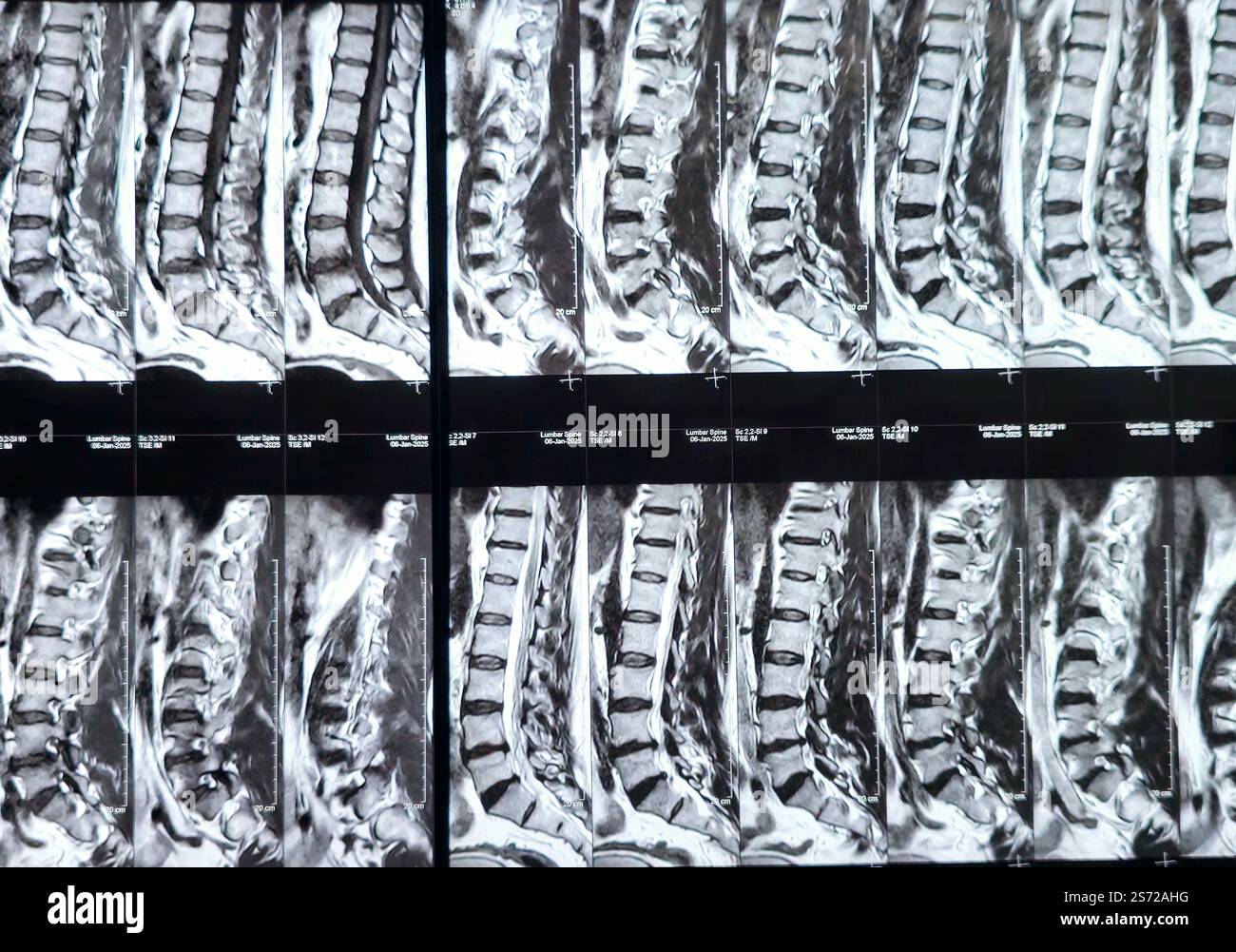 Magnetic Resonance Imaging MRI of the lumbosacral spine shows Spondylodegenerative changes of ...