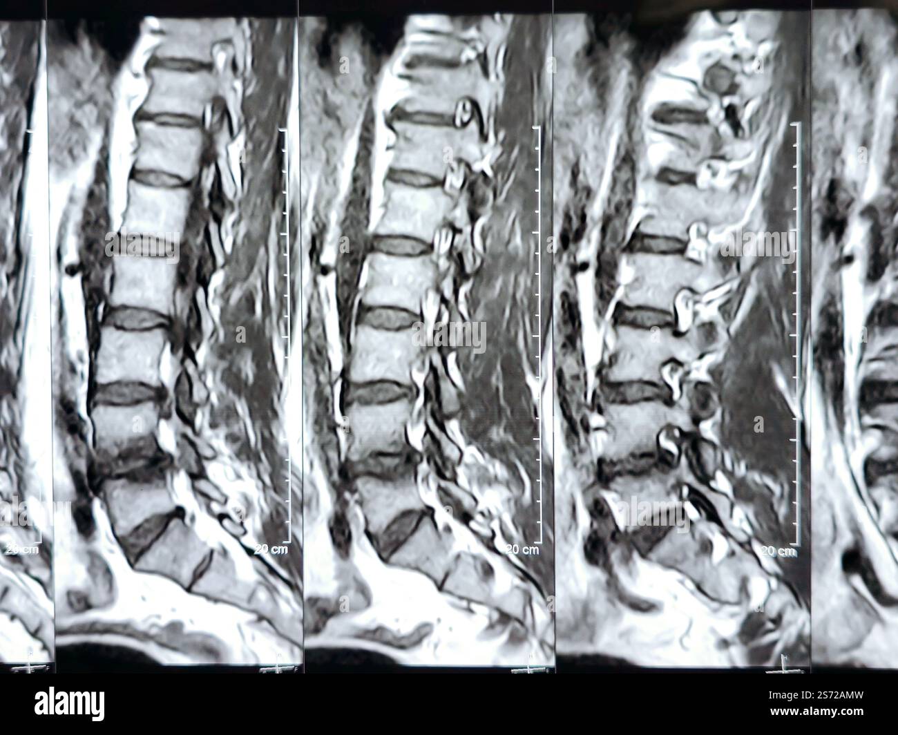 Magnetic Resonance Imaging MRI of the lumbosacral spine shows Spondylodegenerative changes of ...