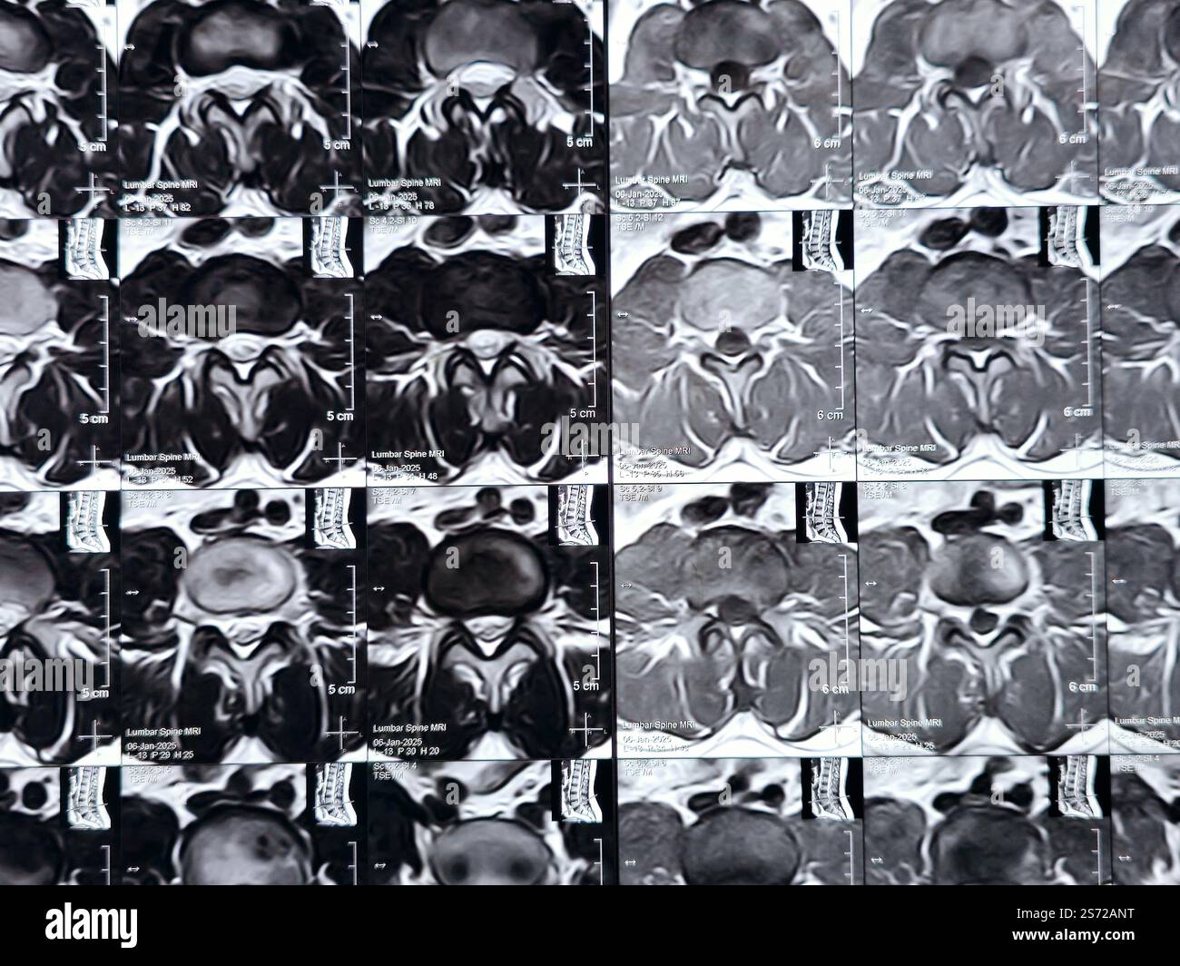 Magnetic Resonance Imaging MRI of the lumbosacral spine shows ...
