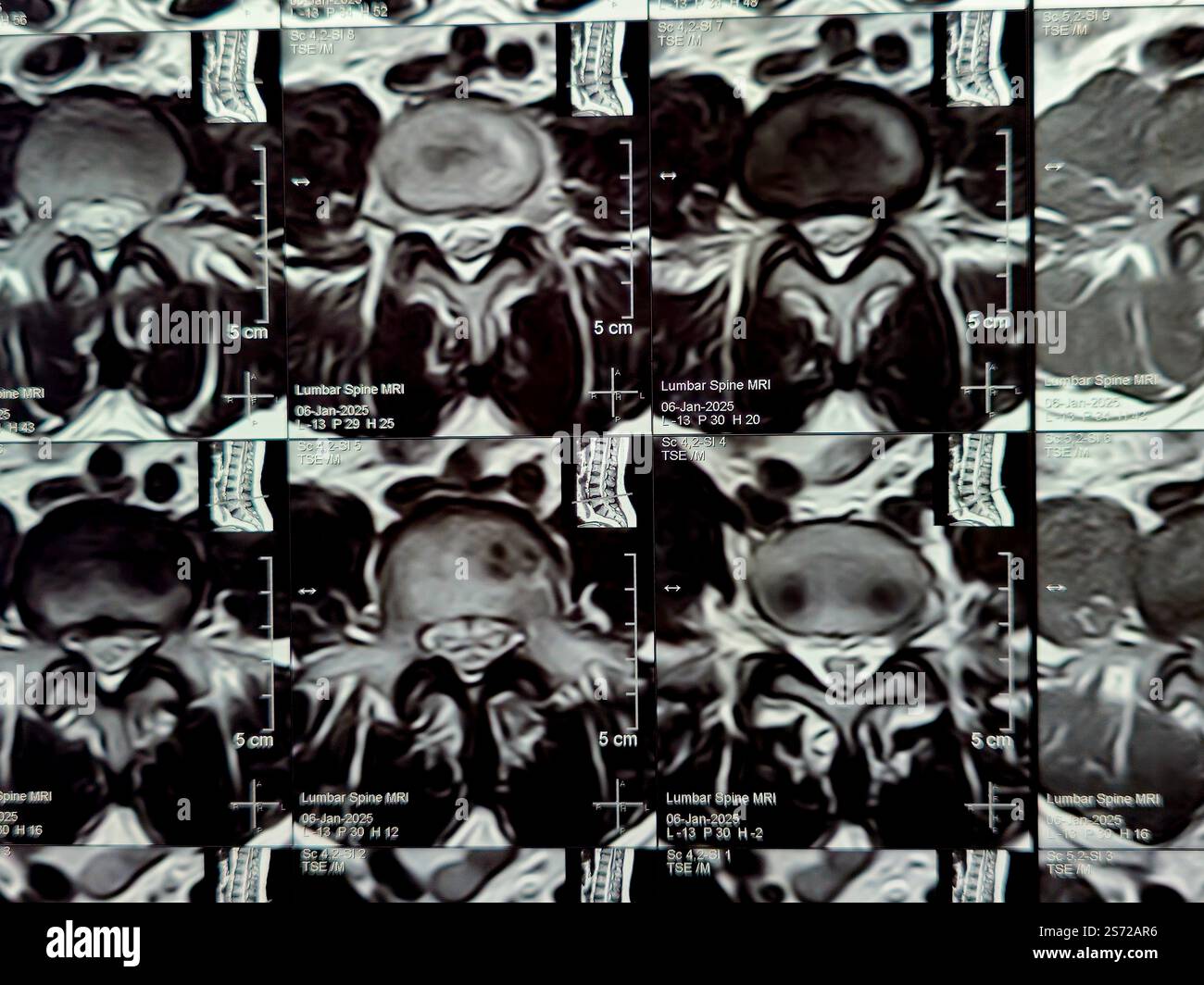 Magnetic Resonance Imaging MRI of the lumbosacral spine shows ...