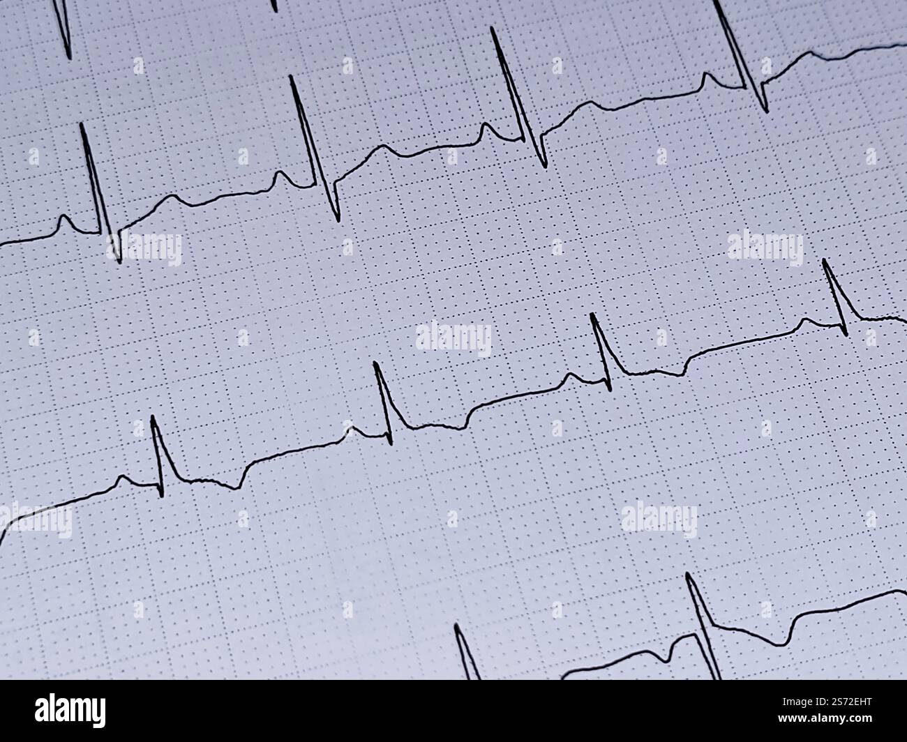 ECG ElectroCardioGraph paper that shows inferolateral T wave changes ...