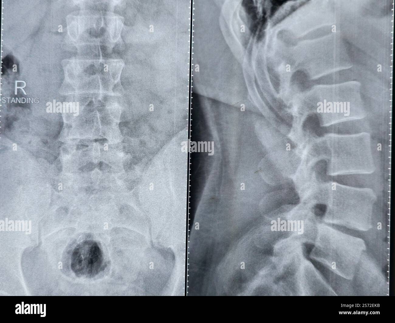 X-ray lumbosacral spine shows straightening of lumbar lordosis due to ...