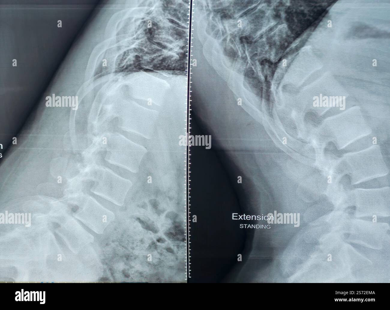 X-ray lumbosacral spine shows straightening of lumbar lordosis due to ...